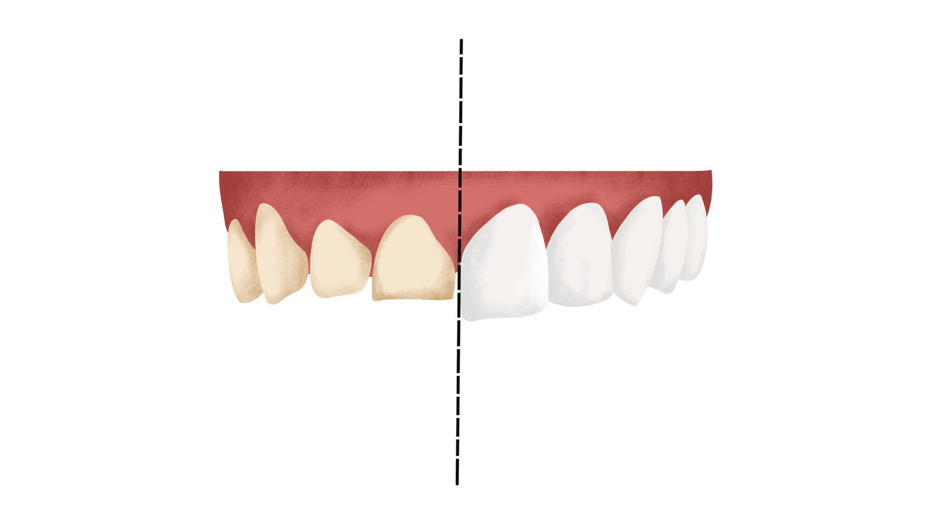 8 Must-Know Tips for First-Time Porcelain Veneers Users